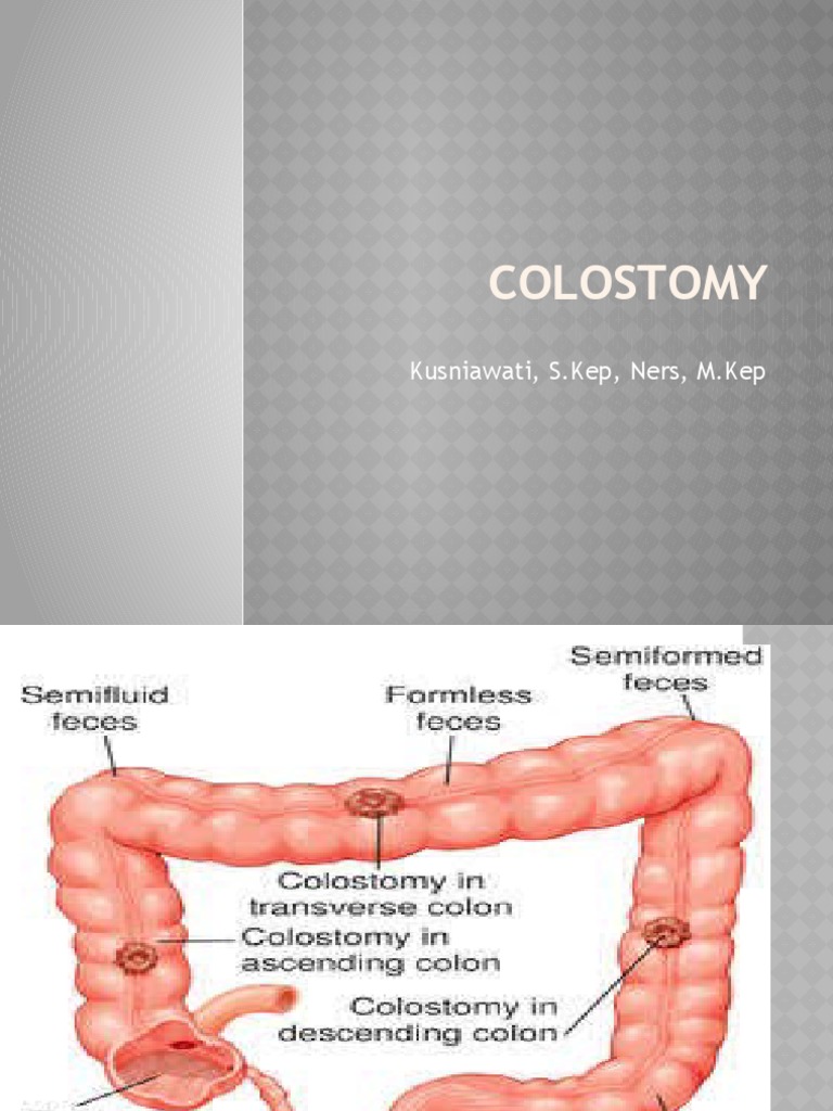 Colostomy: Kusniawati, S.Kep, Ners, M.Kep | PDF