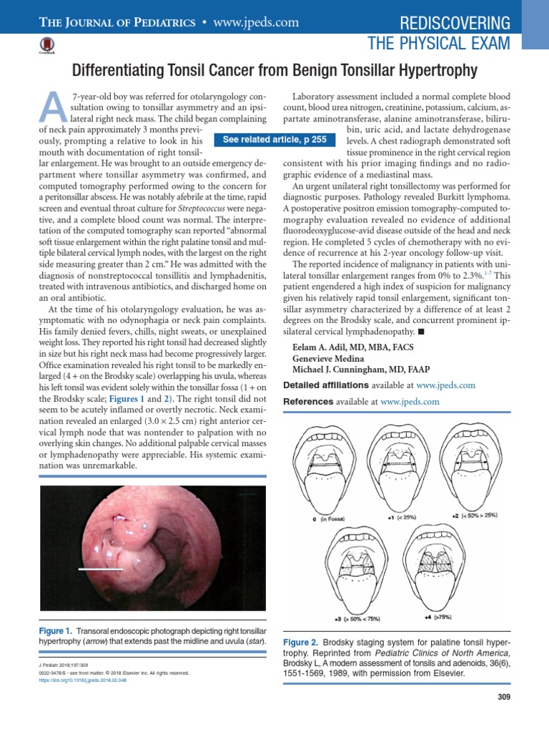 Differentiating Tonsil Cancer From Benign Tonsillar Hypertrophy | PDF | Epidemiology | Medical ...