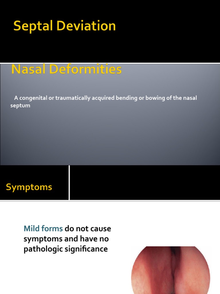 A Congenital or Traumatically Acquired Bending or Bowing of The Nasal ...