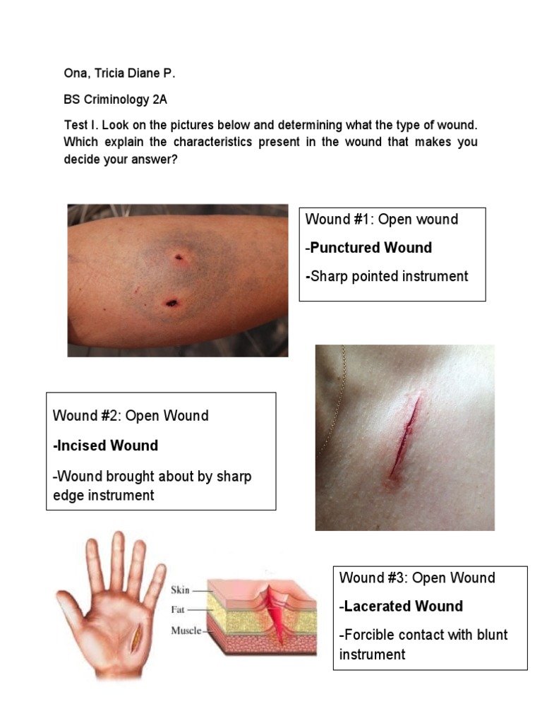 Wound #1: Open Wound - Punctured Wound: - Sharp Pointed Instrument | PDF
