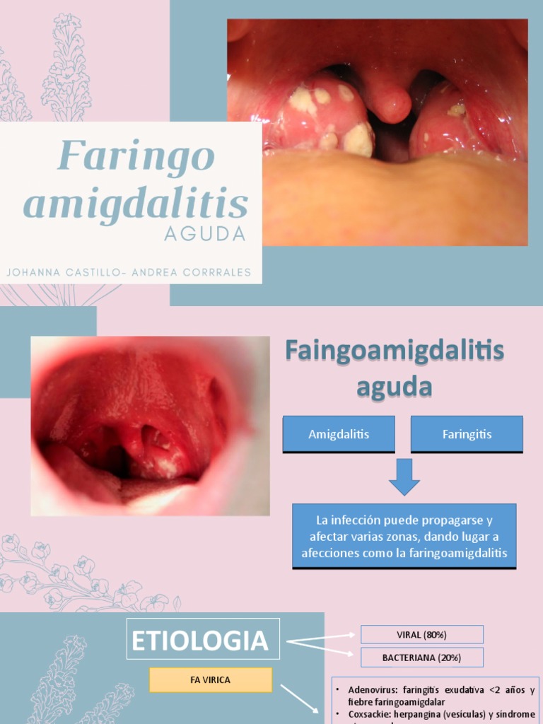 Faringoamigdalitis | PDF