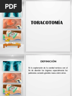 Técnicas y cuidados en lobectomía pulmonar | PDF | Cirugía | Pulmón