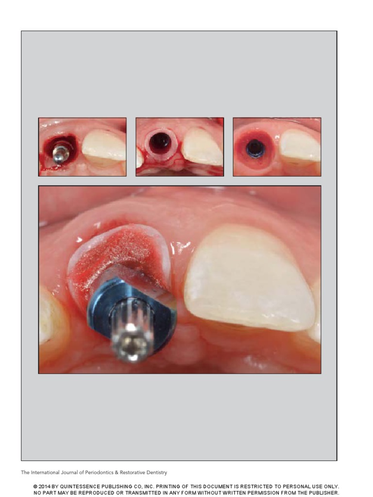 The International Journal of Periodontics & Restorative Dentistry | PDF ...