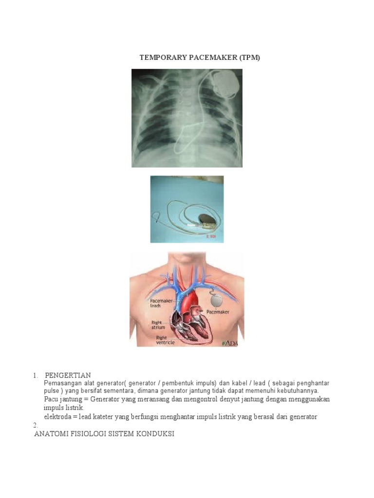 Pemasangan Temporary Pacemaker Jantung | PDF