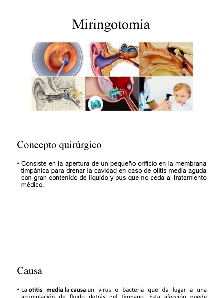 Miringotomía y Adenoamigdalectomía | PDF | Oído | Apnea del sueño