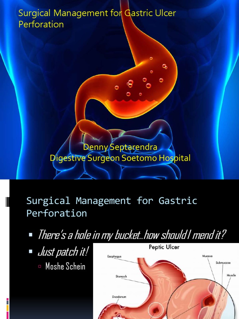 Surgical Management For Gastric Ulcer Perforation | PDF | Surgery ...