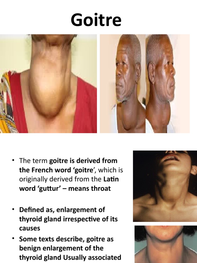Goitre | PDF | Thyroid | Hyperthyroidism