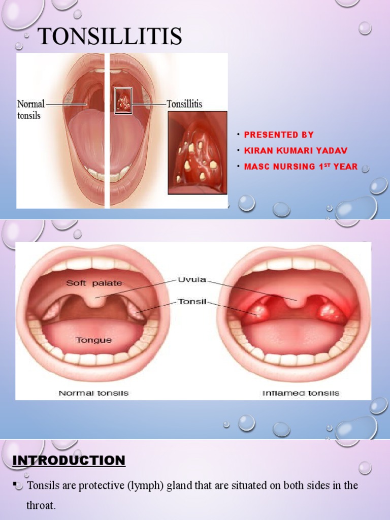 ON TONSILITIS (Autosaved) | PDF | Medical Specialties | Diseases And ...