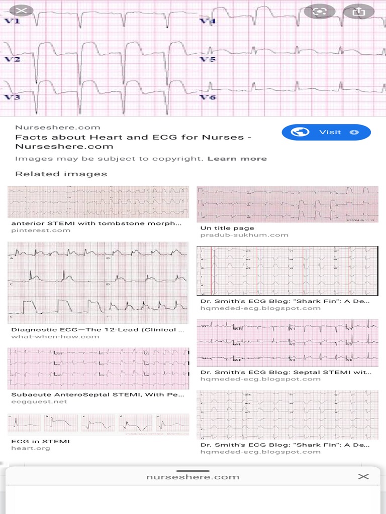 Tombstone Appearance Ecg - Google Search | PDF