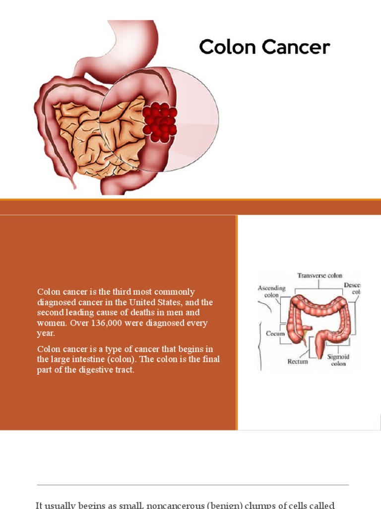 Colon Cancer: Causes, Symptoms, Stages & Treatment | PDF | Colorectal ...