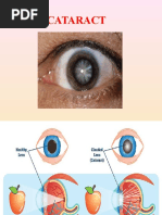 Cataract Coding Guidelines and ICD-10 | PDF | Cataract | Glaucoma