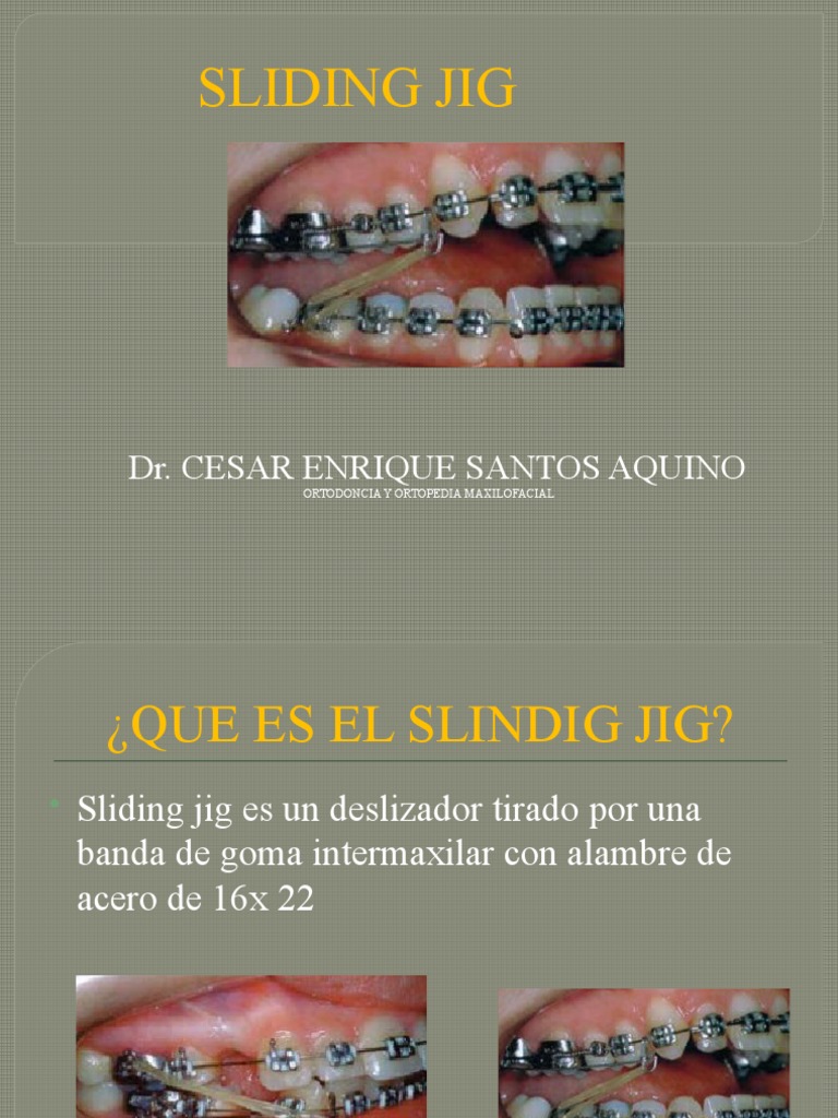 Sliding Jig en Ortodoncia: Eficiencia y Uso | PDF | Ciencia y ...