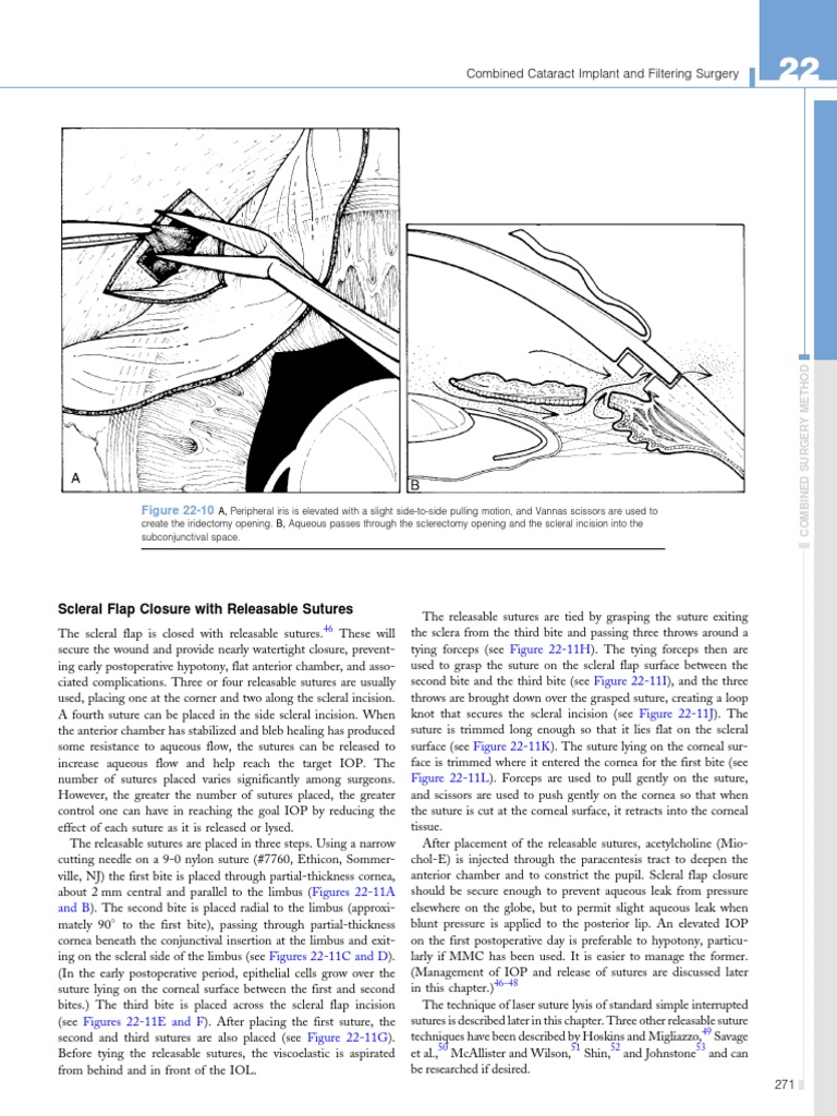 Combined Cataract Implant and Filtering (1) (13-23) | PDF | Surgical ...