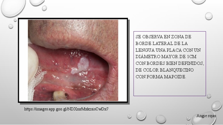 Leucoplasia en Lengua: Placa Mapoide | PDF