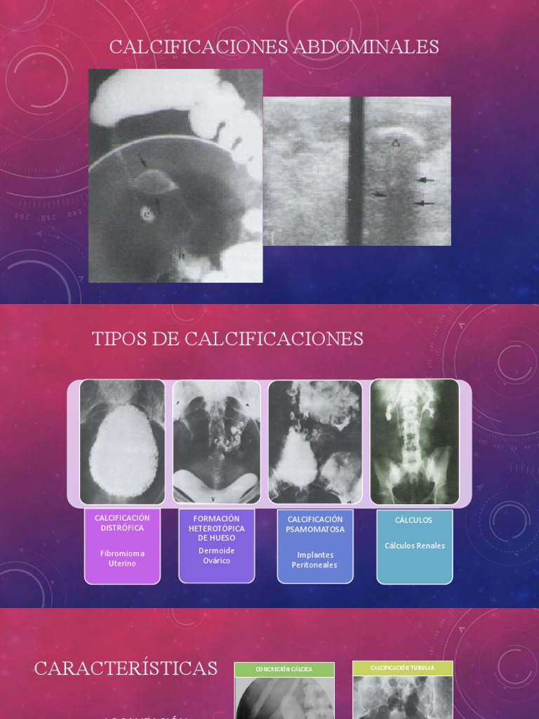 Tipos y causas de calcificaciones abdominales | PDF | Medicina CLINICA ...