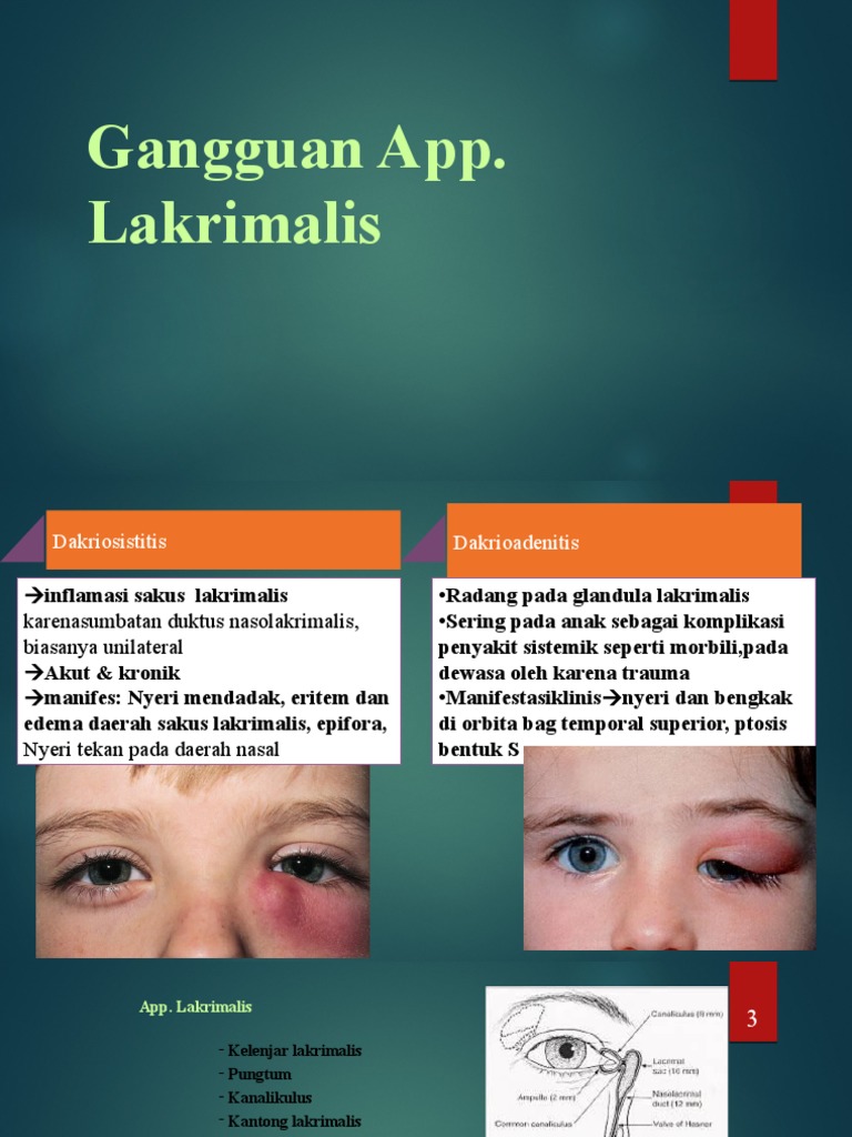 Gangguan App Lakrimalis Dan Selulitis Orbita | PDF