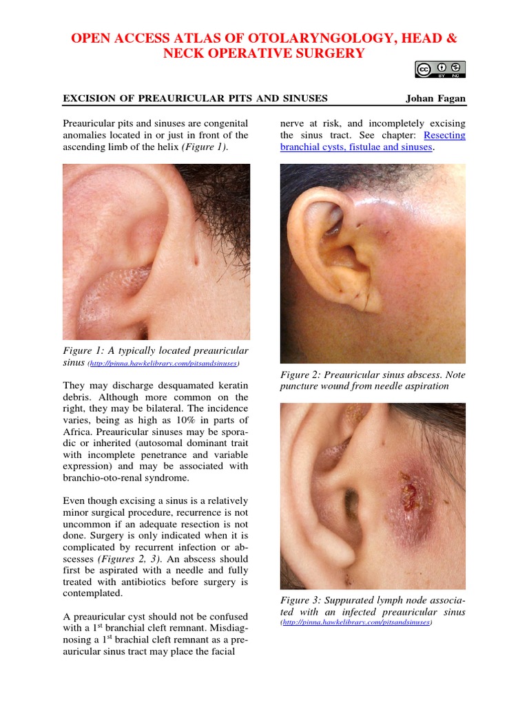 Preauricular Pit Infection