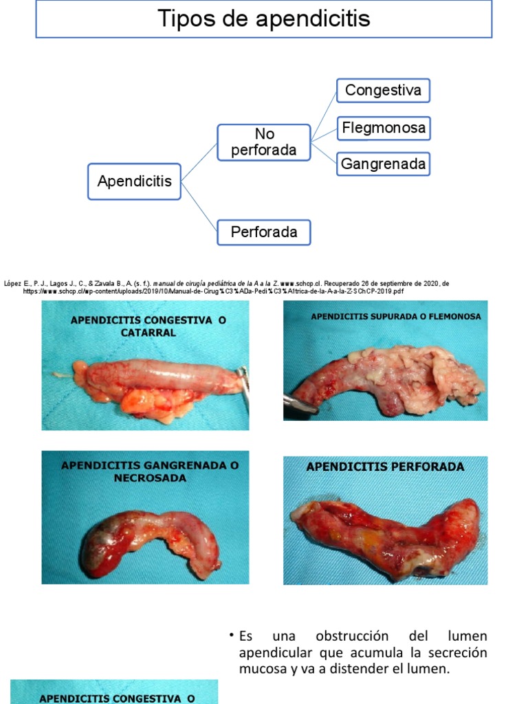 Tipos de Apendicitis | PDF | Rtt | Inmunología