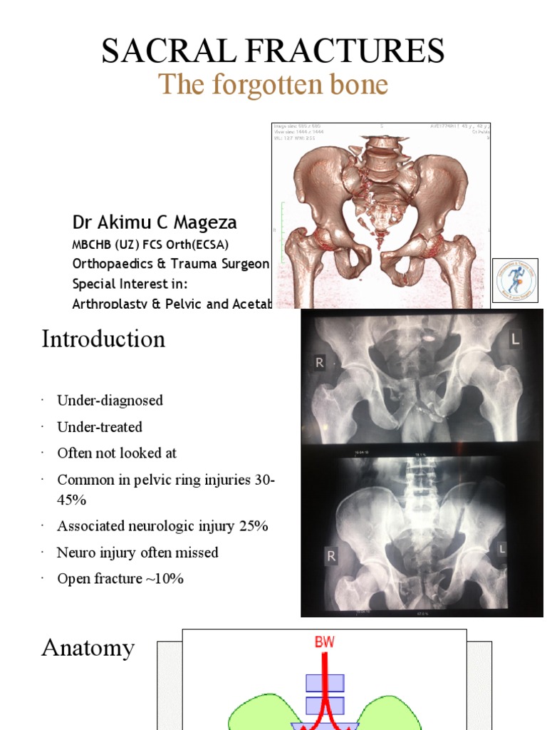 Sacral Fractures: The Forgotten Bone | PDF | Pelvis | Back Pain