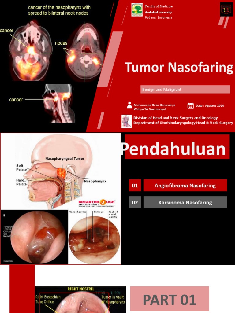 Tumor Nasofaring | PDF