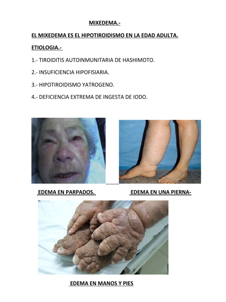 Mixedema | PDF