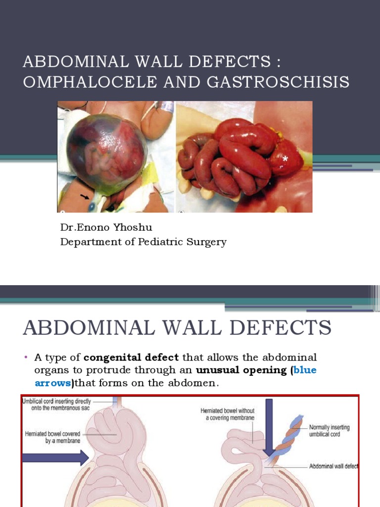 Abdominal Wall Defects: Omphalocele and Gastroschisis: DR - Enono ...