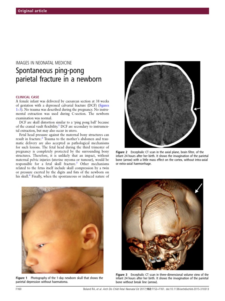 Spontaneous Ping-Pong Parietal Fracture in A Newborn: Images in ...