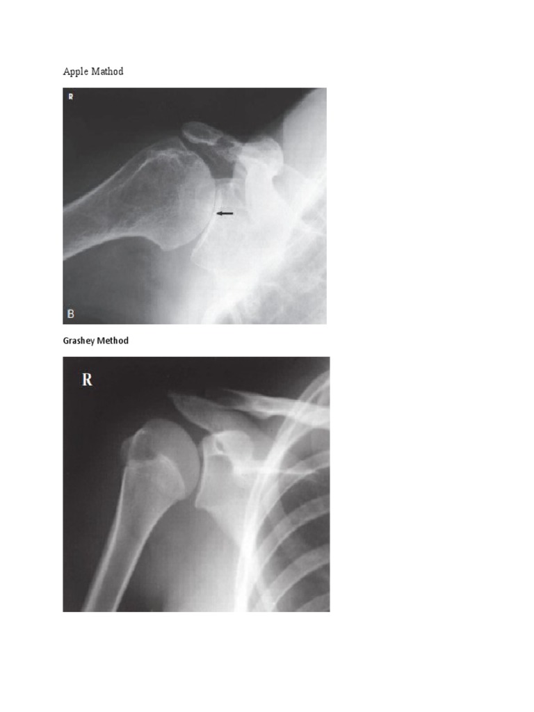 Apple Mathod: Grashey Method | PDF