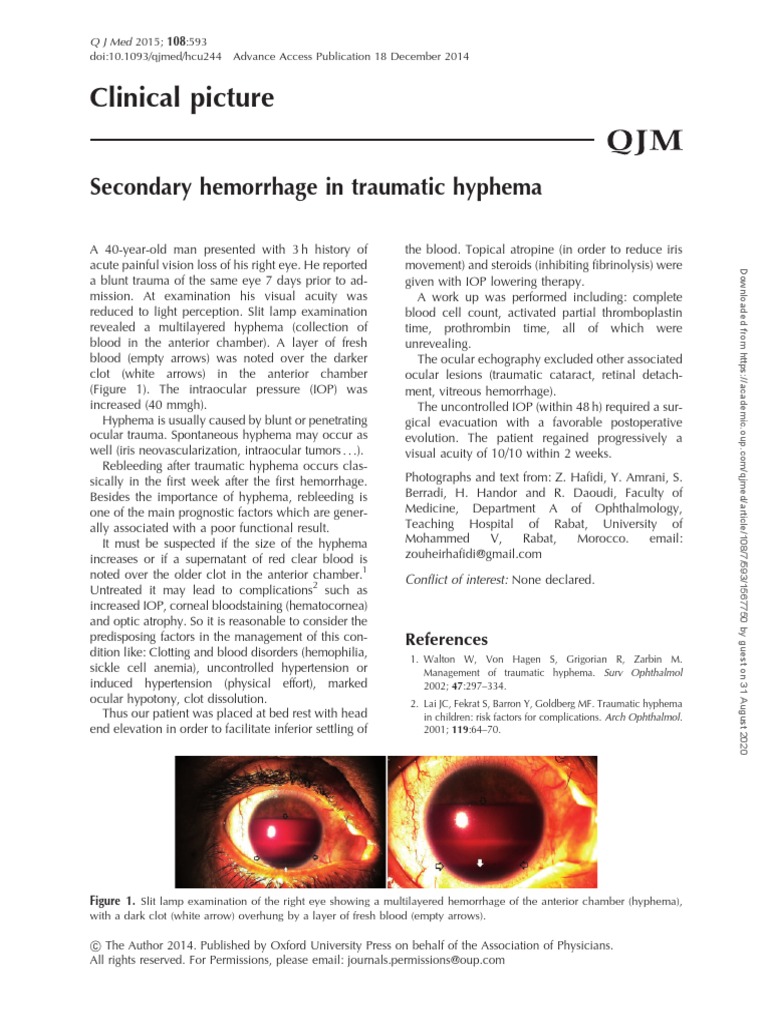 Clinical Picture: Secondary Hemorrhage in Traumatic Hyphema | PDF ...