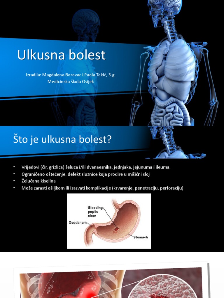 Ulkus - Powerpoint Prezentacija | PDF