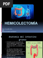 Sigmoidectomía Laparoscópica: Técnica y Equipo | PDF | Intestino grueso ...