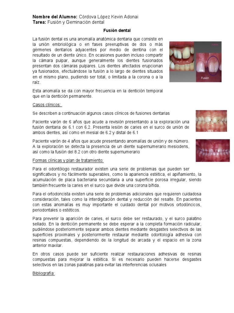Fusión y Geminación Dental | PDF | Diente | Odontología
