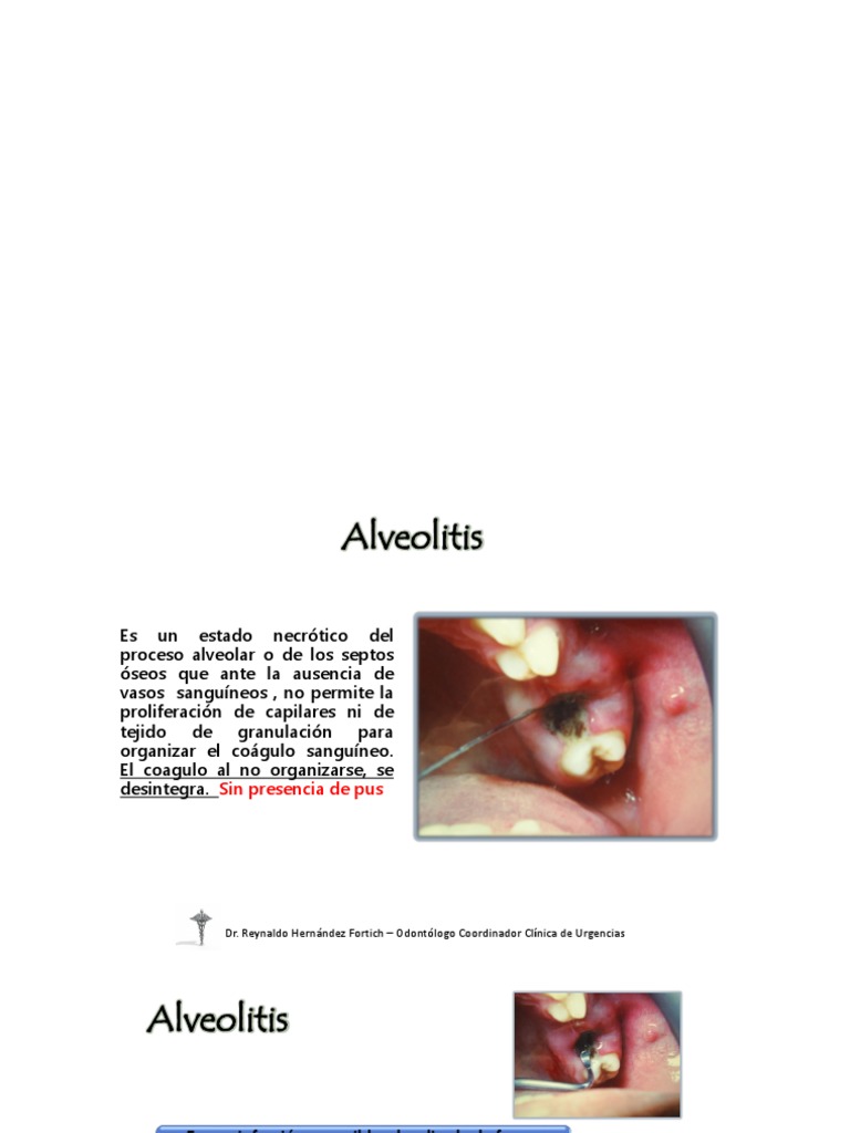 Alveolitis PDF | PDF | Odontología | Medicina CLINICA