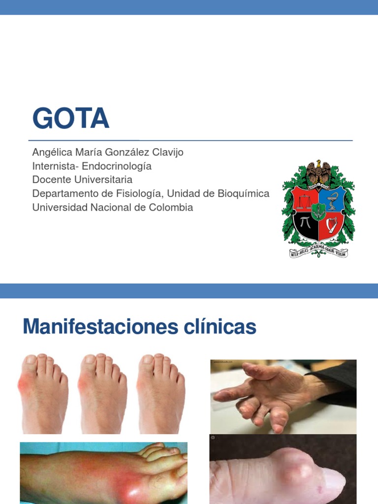 Gota PDF | PDF | Gota | Inflamación