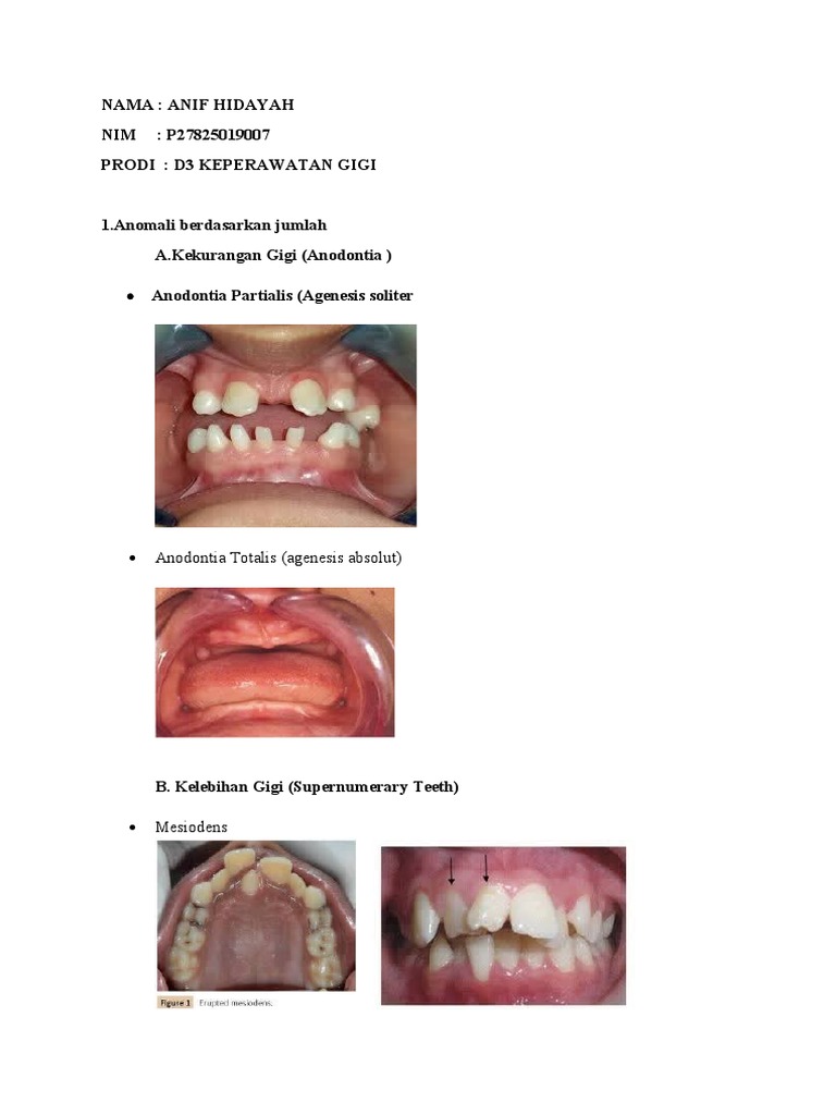 Tugas Anomali Gigi | PDF