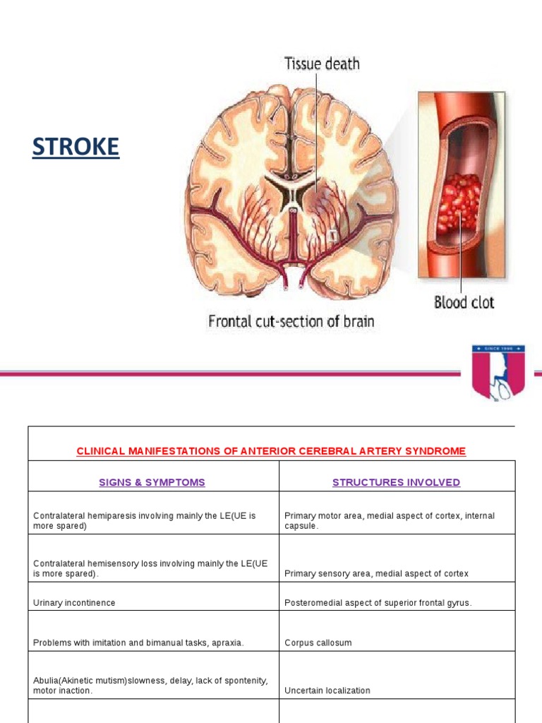 Stroke | PDF | Parietal Lobe | Cerebral Cortex