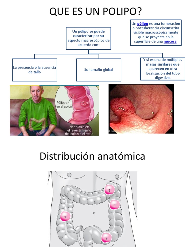 Colon-Colostomia-Enfermedad Diverticular-Polipos-Sindrome de Poliposis ...
