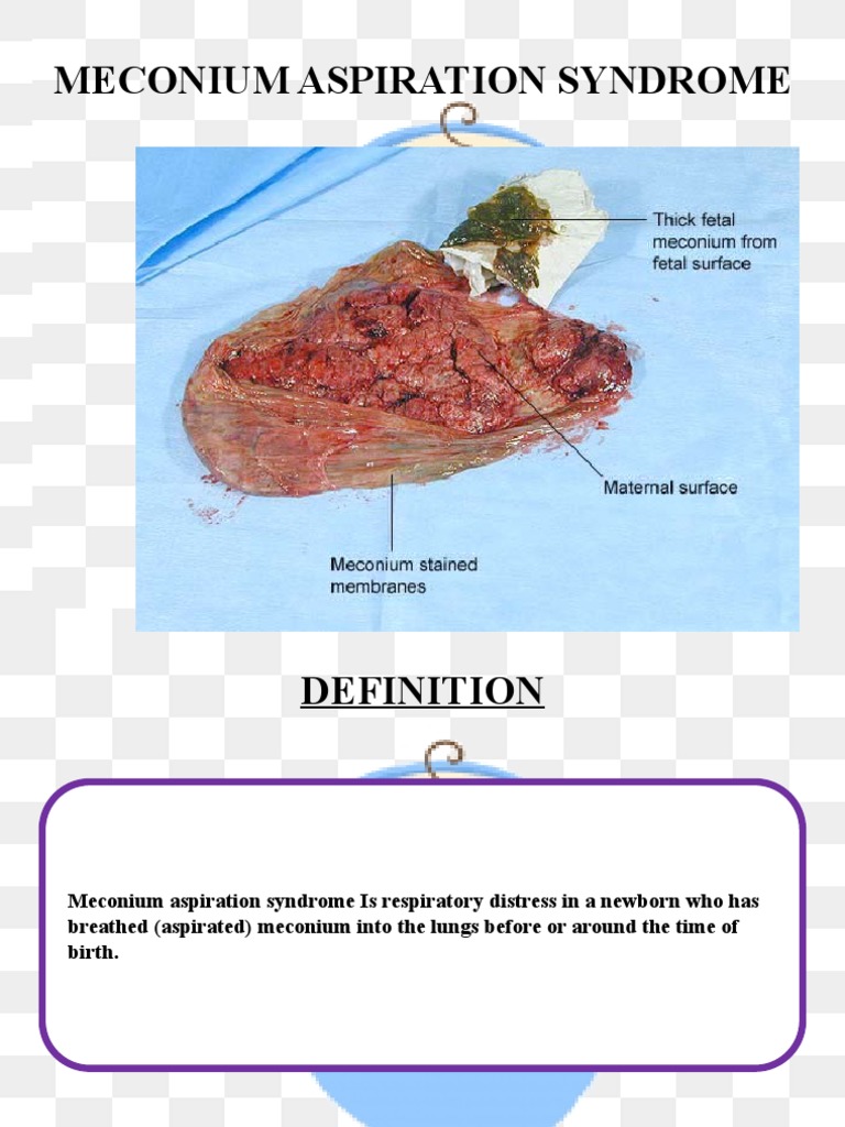 Understanding Meconium Aspiration Syndrome | PDF | Medical Specialties ...