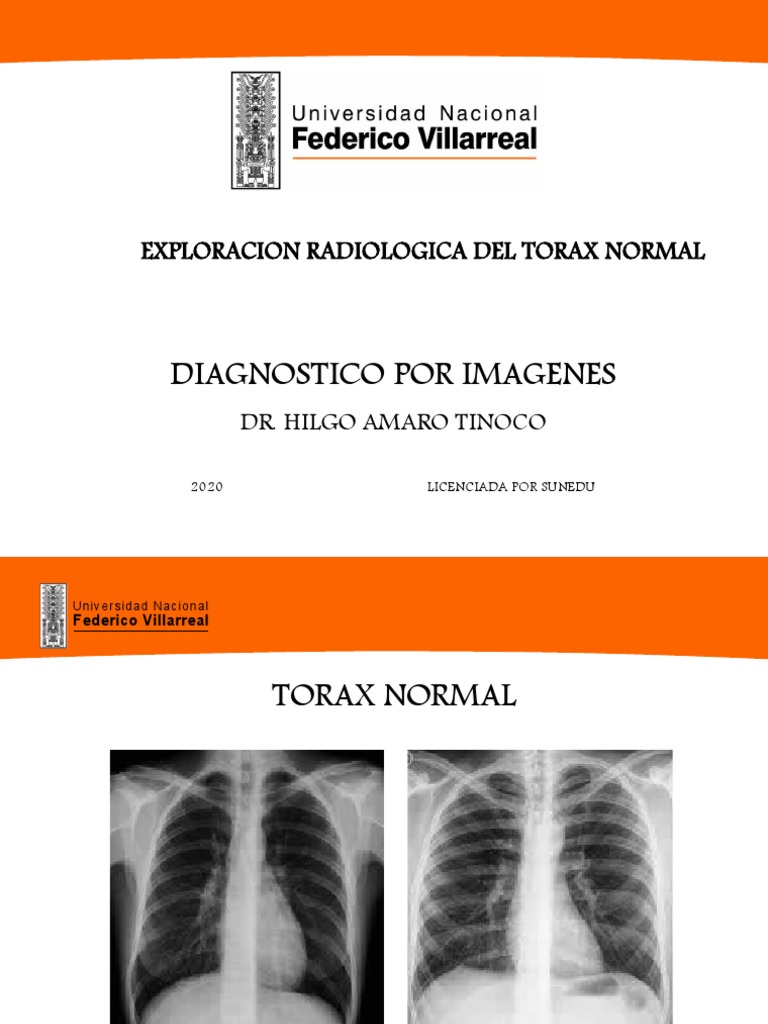RX Torax Normal - Unfn, 2020 | PDF | Laringe | Radiología