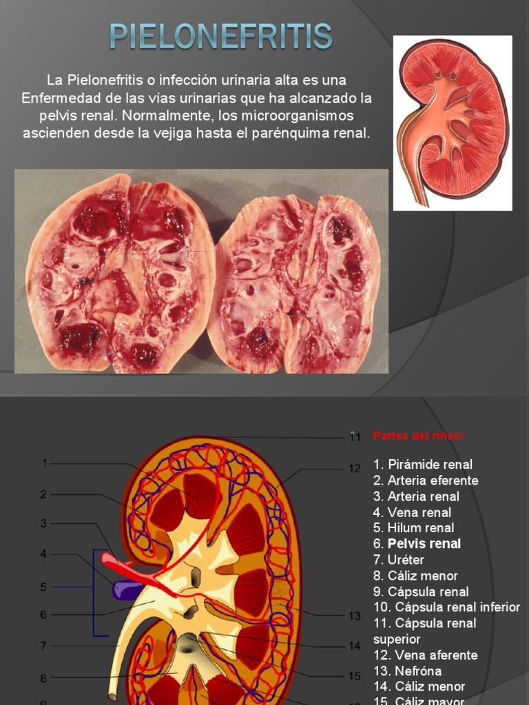 Pielonefritis: Síntomas y Tratamiento | PDF | Ciencias de la Salud ...