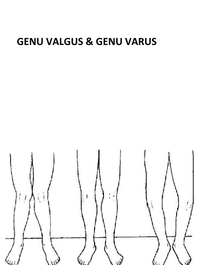 Genu Valgus Genu Varus | PDF | Foot | Human Diseases And Disorders