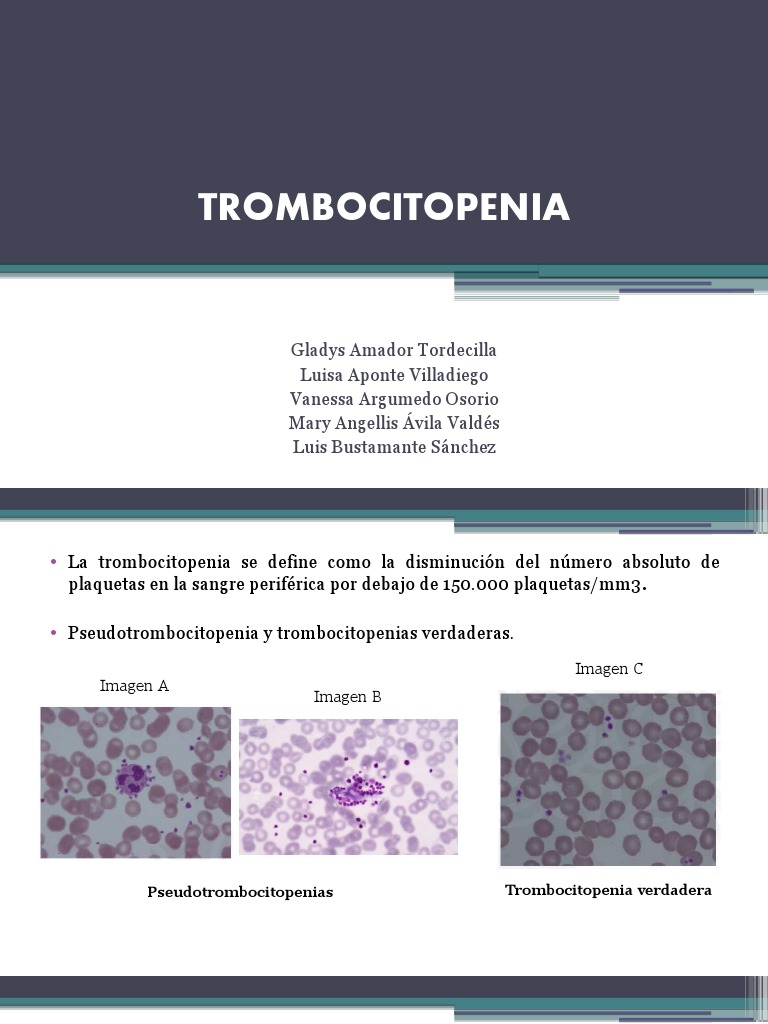 TROMBOCITOPENIA | PDF | Plaqueta | Leucemia