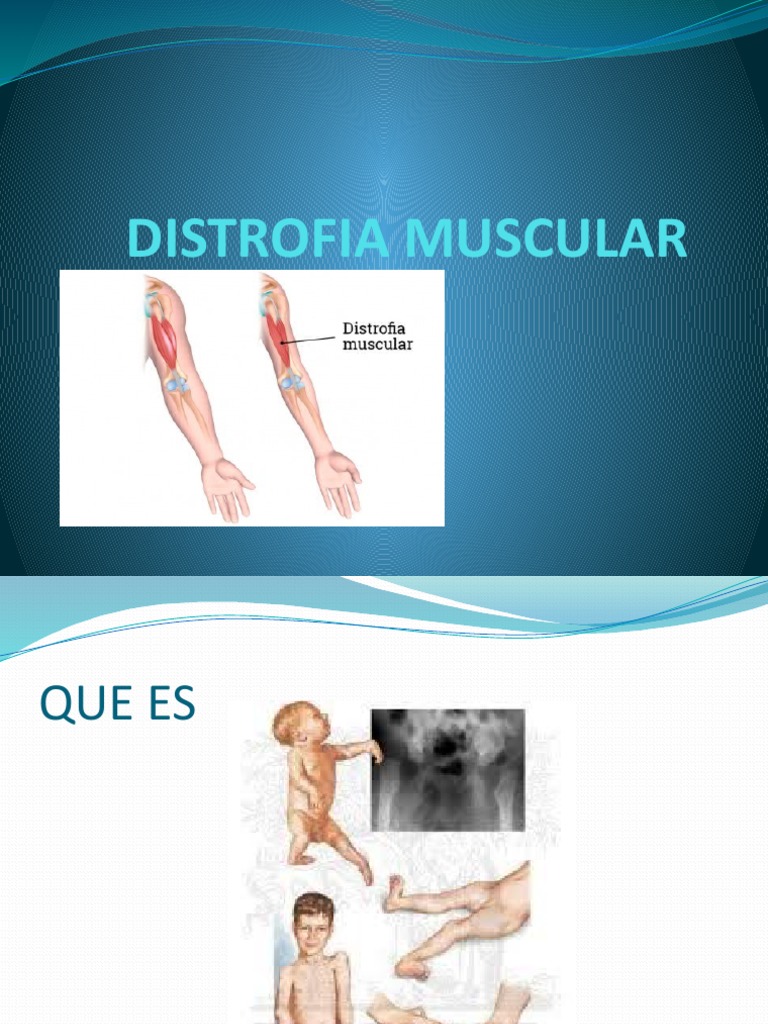 1.distrofia Muscular Diapositivas | PDF