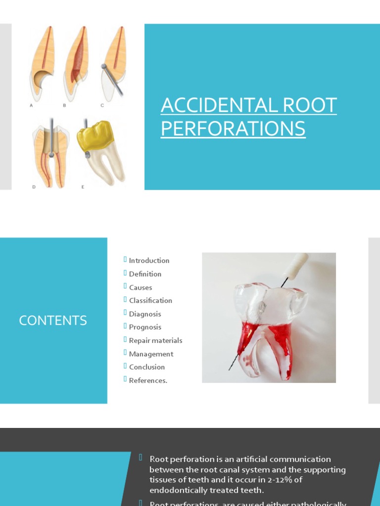 Root Perforation: Causes and Management | PDF | Periodontology | Human ...