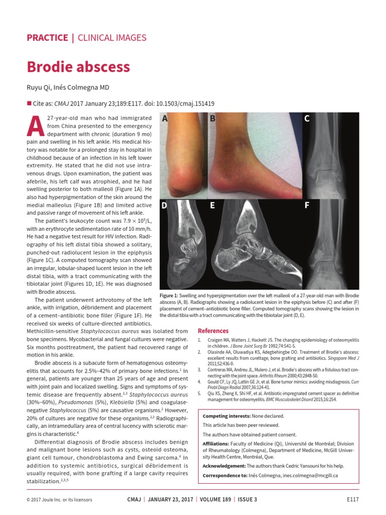 Brodie Abscess | PDF | Ankle | Health Sciences