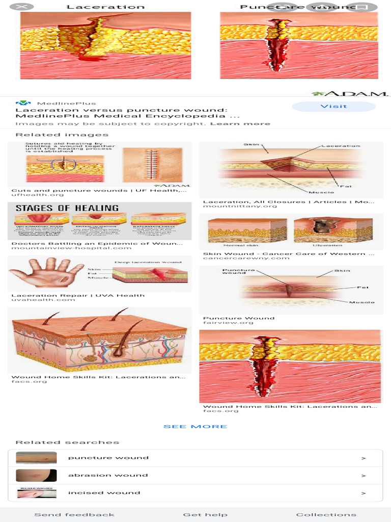 Deep Abrasion Diagram Wound - Google Search | PDF