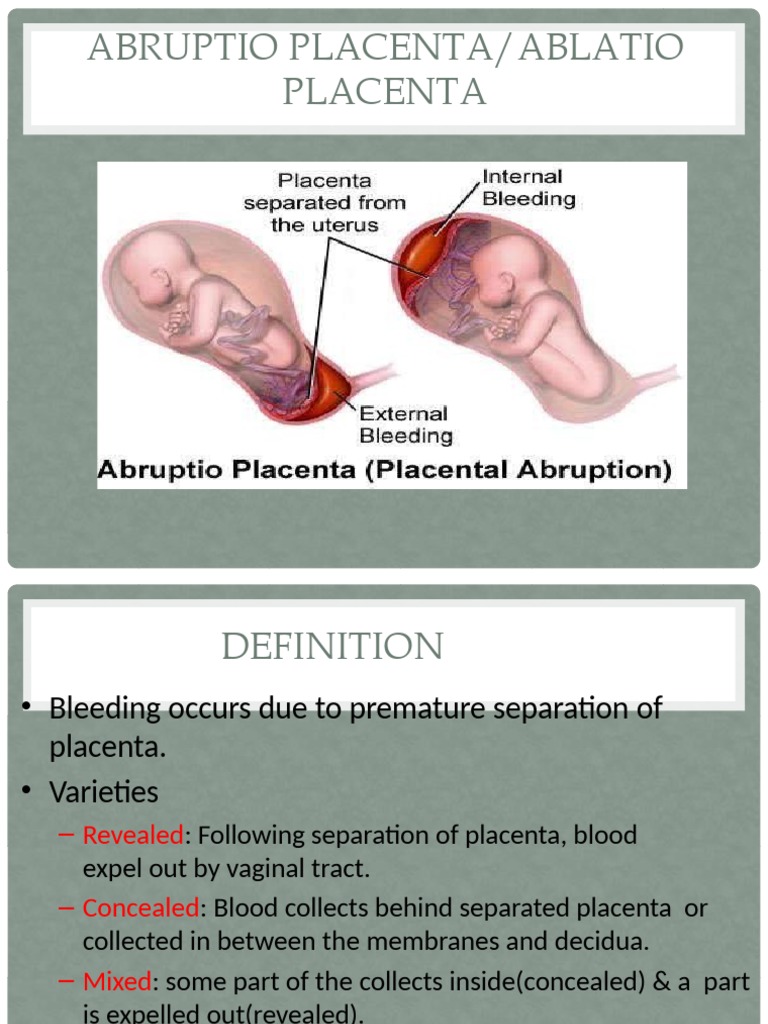 Abruptio Placenta For Students | PDF | Obstetrics | Childbirth