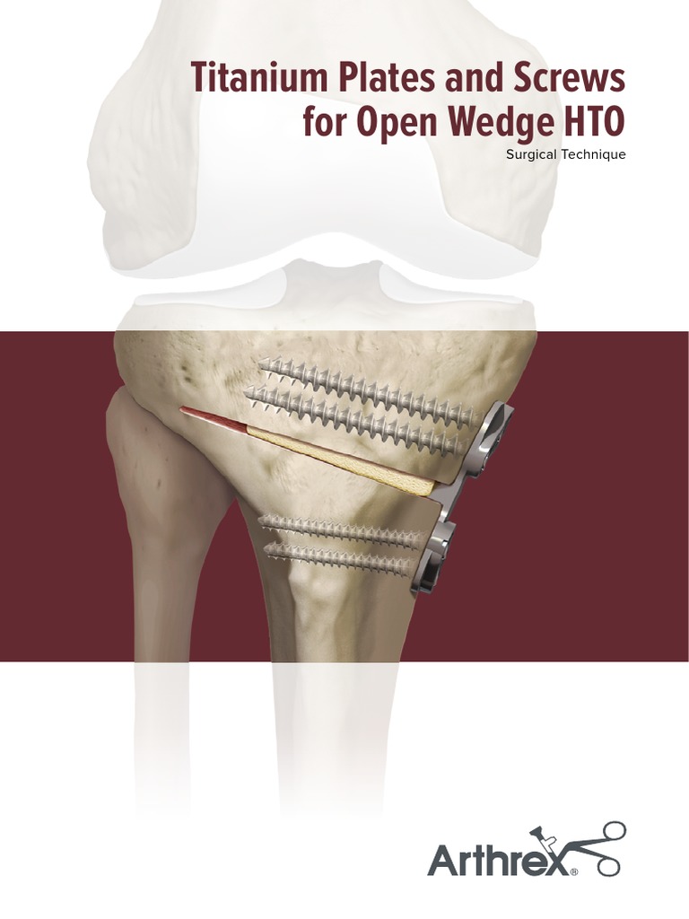 Titanium Plates and Screws For Open Wedge Hto | Download Free PDF ...