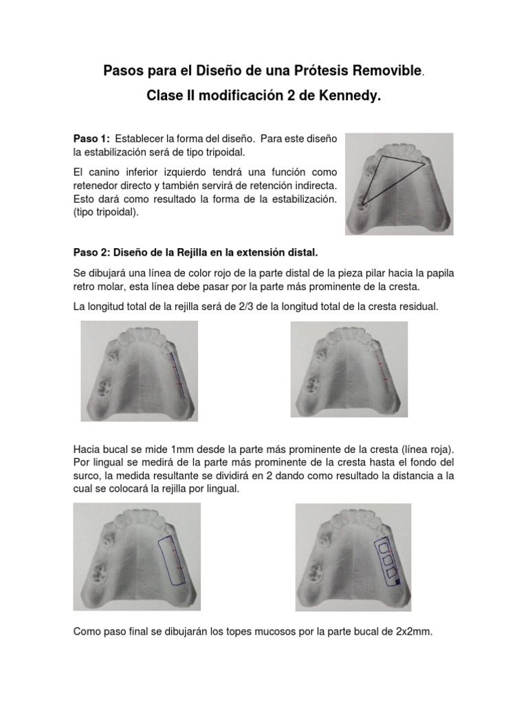 PPR Inferior Con Pilar Intermedio | PDF | Dentadura postiza | Boca