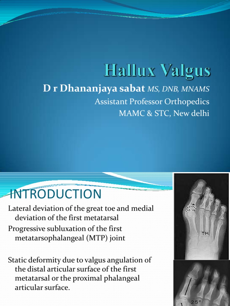 Hallux Valgus PDF | PDF | Toe | Foot